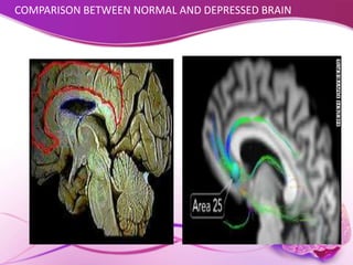 Brain implants By Neelima Sharma,M.Sc Biotechnology,Women Christian ...
