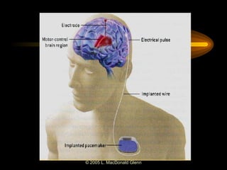 Brain In A Box McGill | PPT