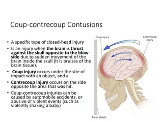 Brain injuries | PPTX