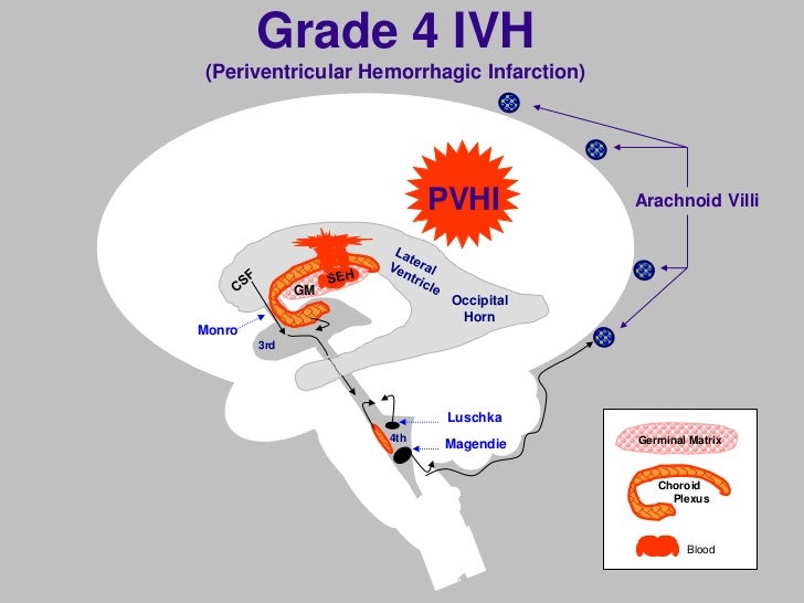 Brain Injury in Pre-Term Infants