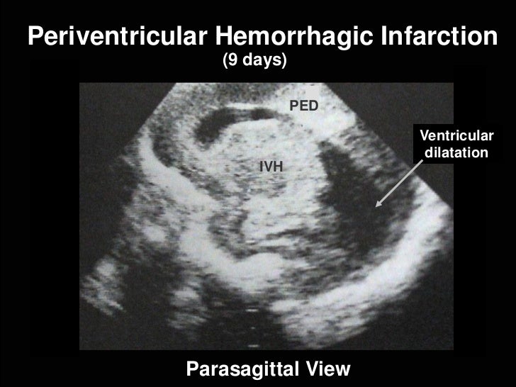 Brain Injury in Pre-Term Infants