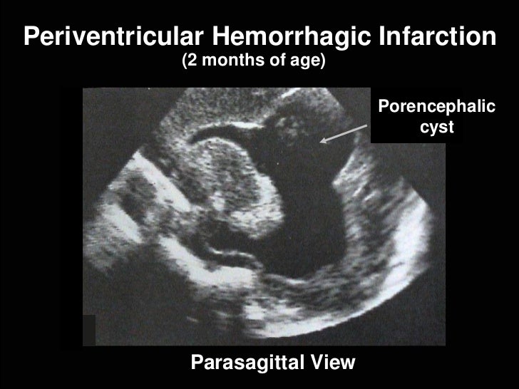 Brain Injury in Pre-Term Infants