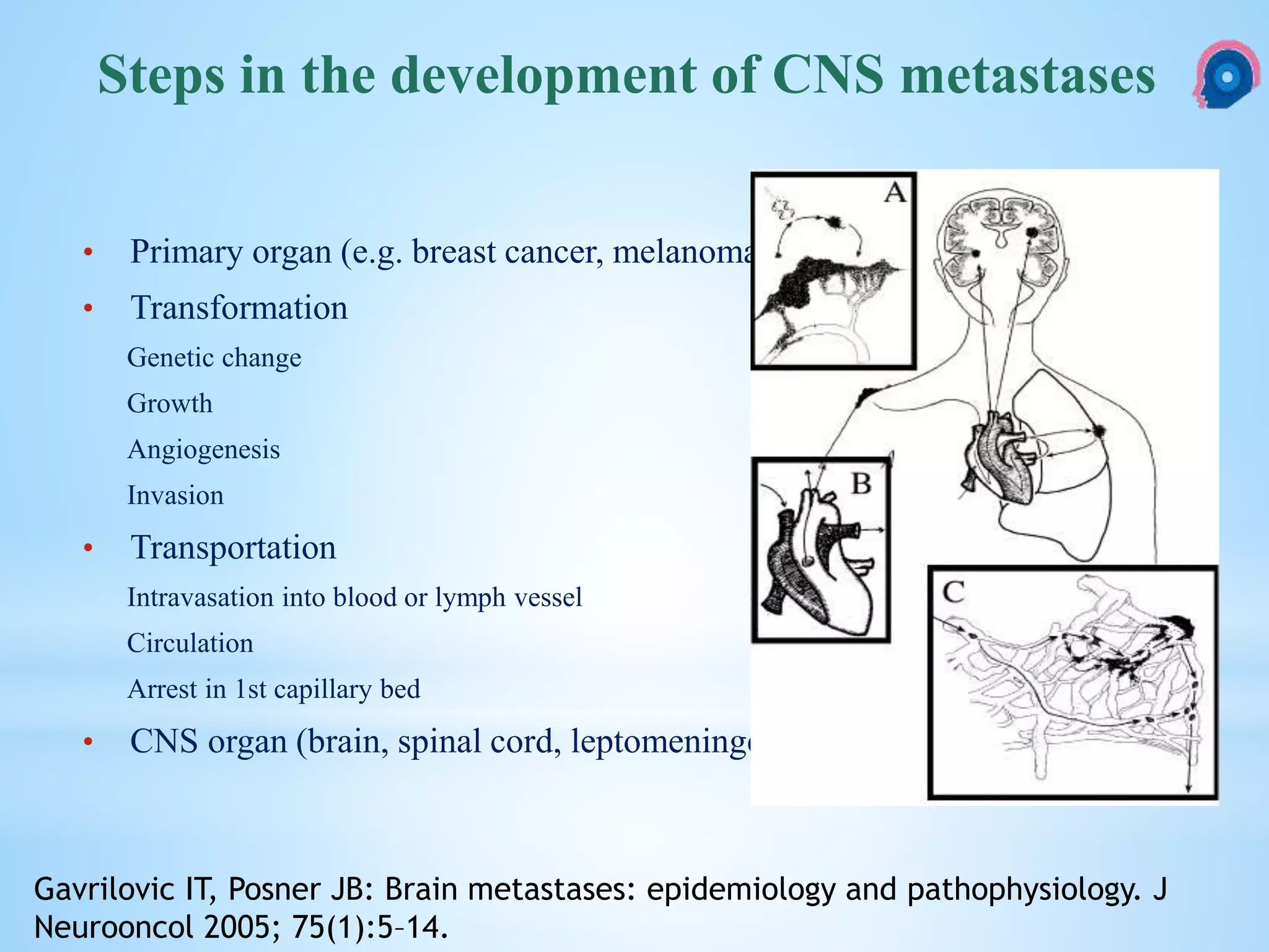 Brain metastasis - Simplified | PPTX