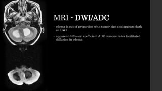 Brain metastasis | PPT