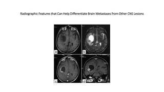 Brain Metastases An Overview Pptx