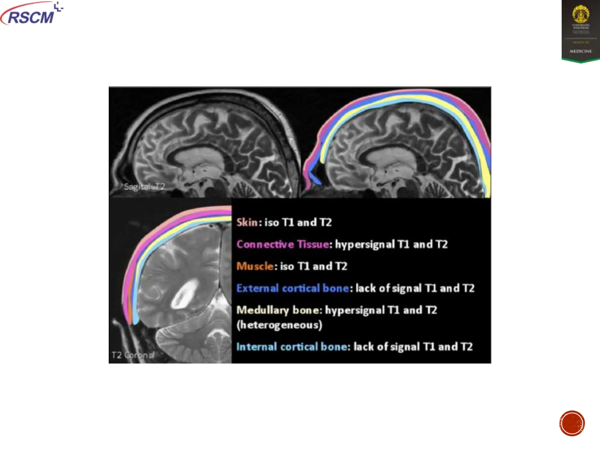 Brain MRI.pptx adalah memberikan gambaran MRI | PPTX
