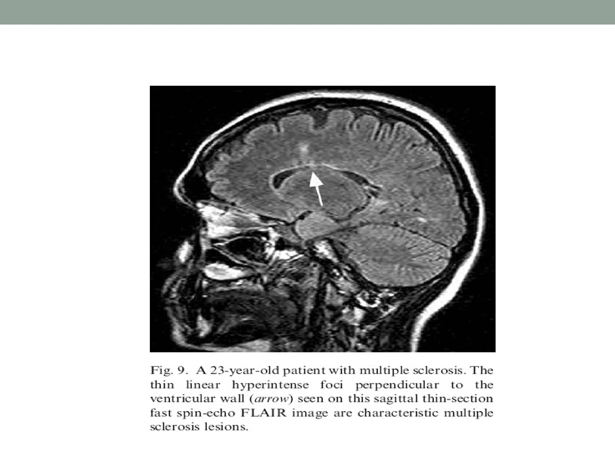 Brain MRI Interpretation - Interpretasi MRI Kepala.ppt