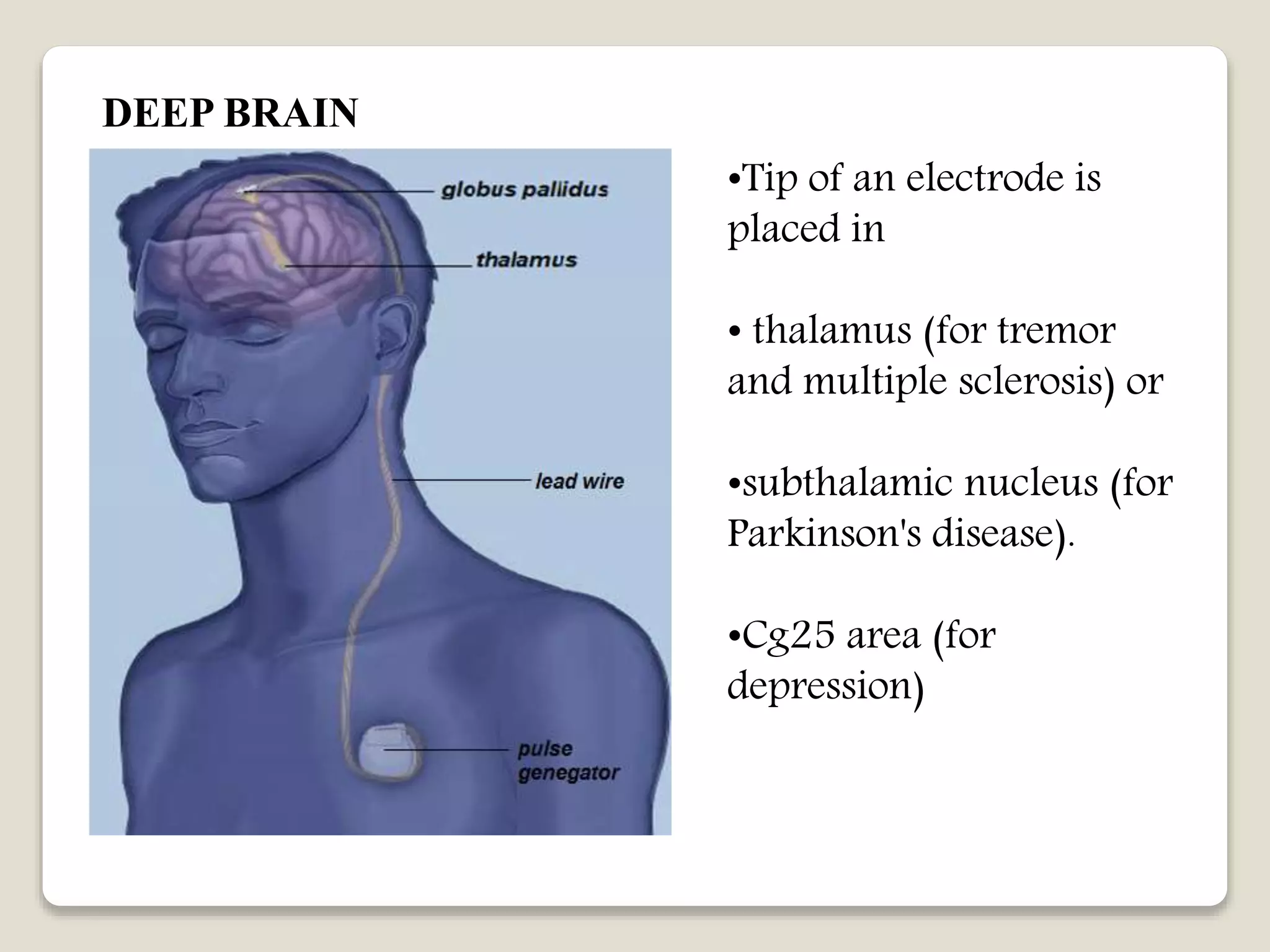 Brain pacemaker | PPT