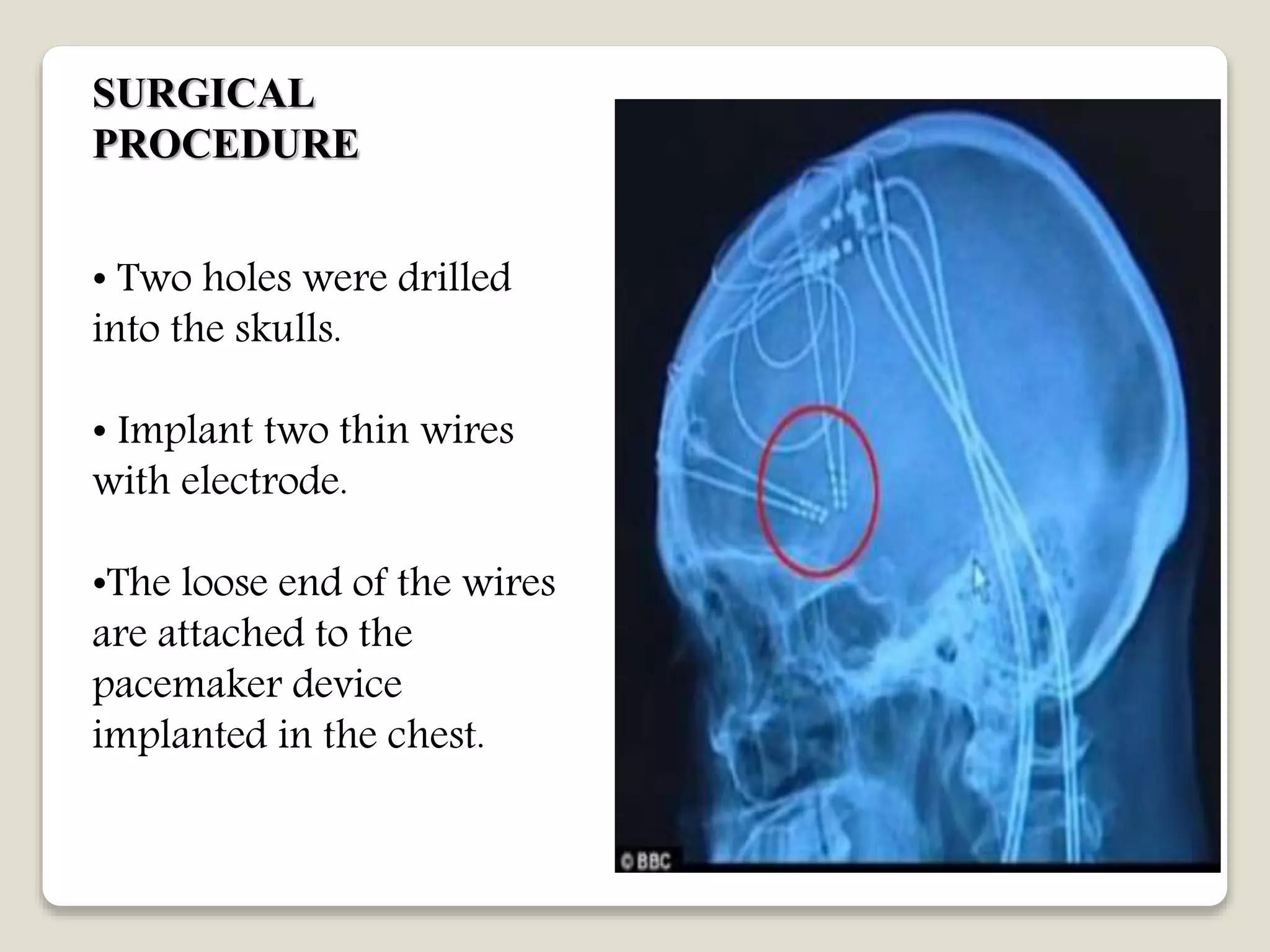 Brain pacemaker | PPT
