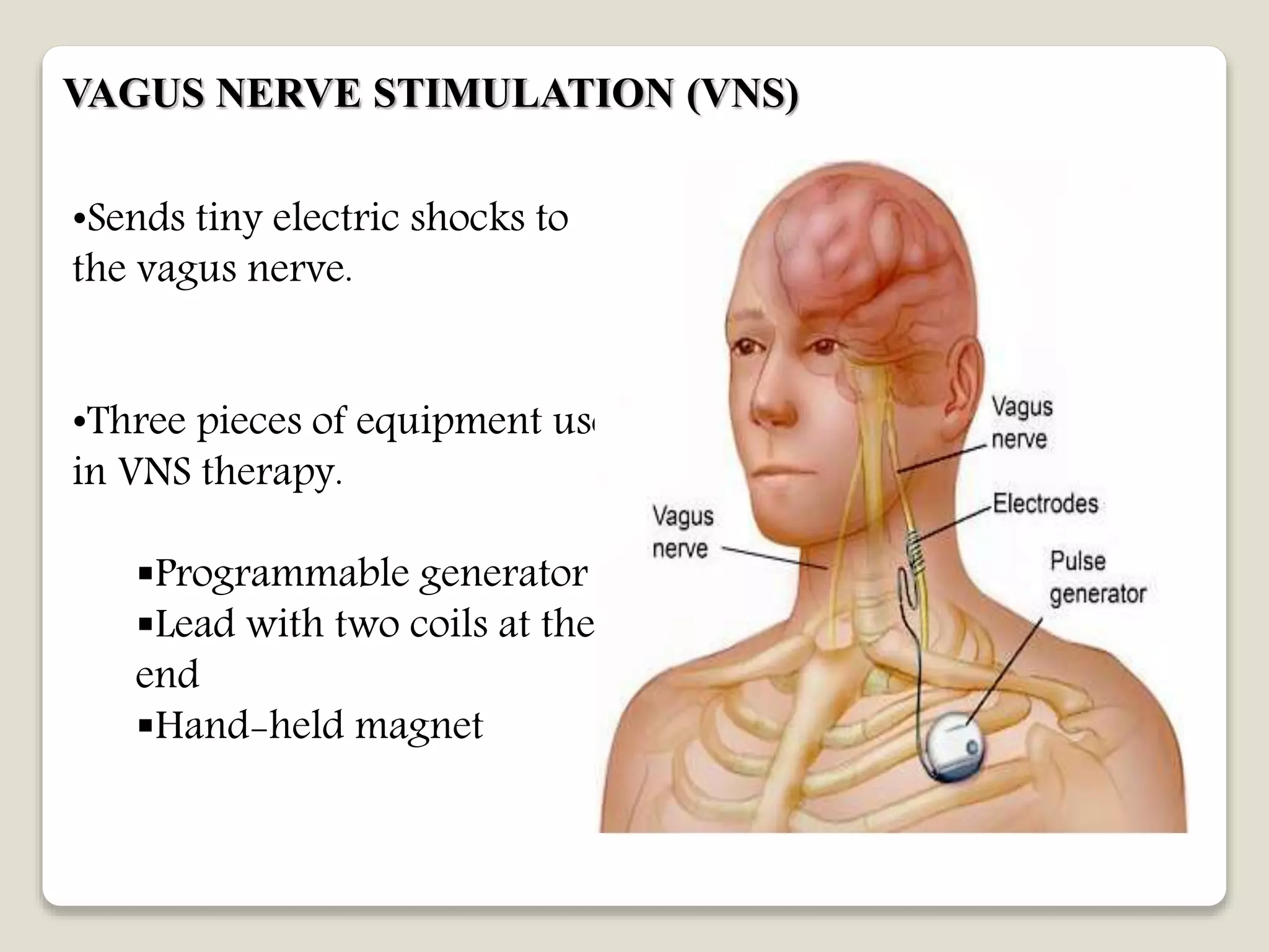 Brain pacemaker | PPT