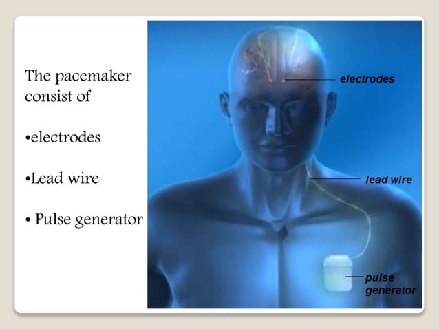 Brain pacemaker | PPT