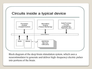 Brain pacemaker | PPT