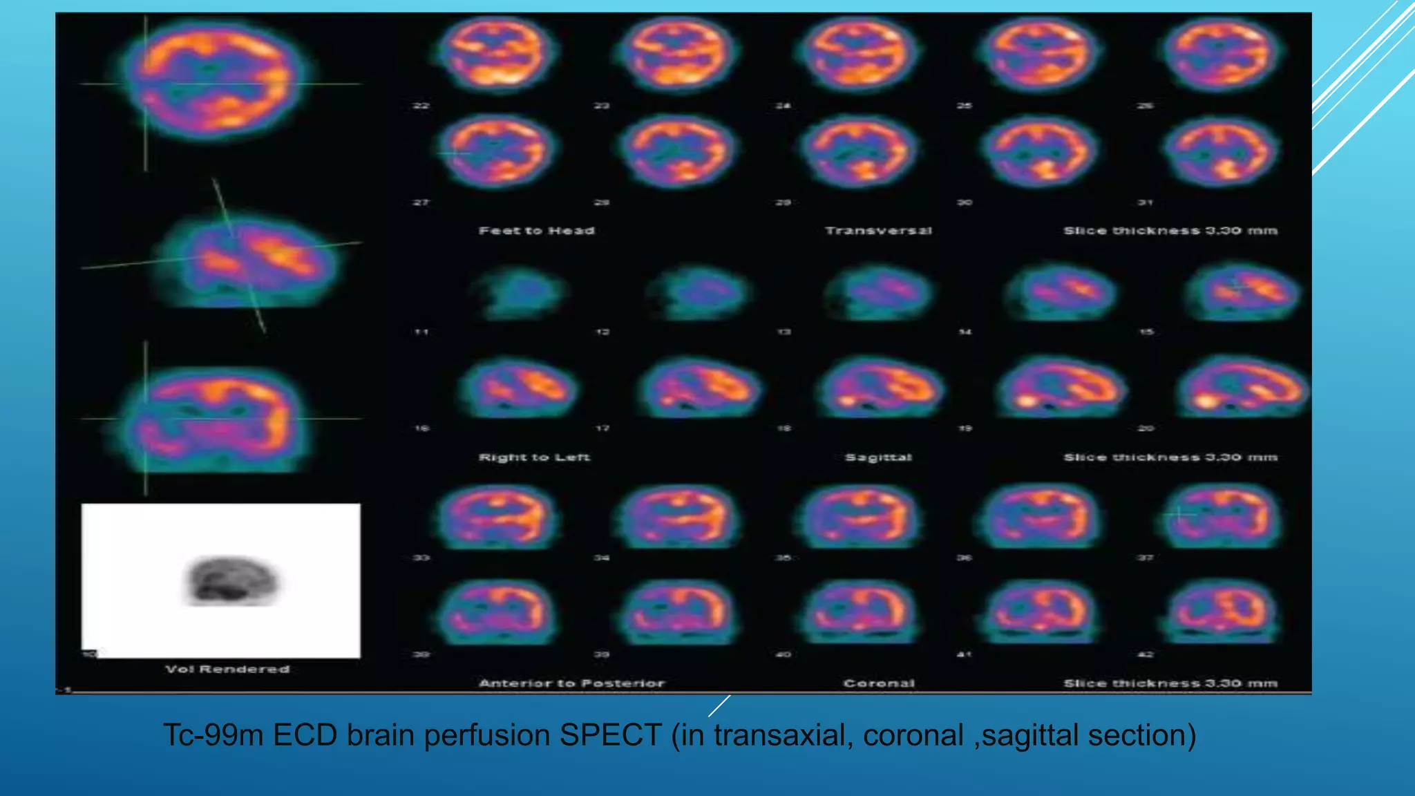 Brain perfusion nuclear medicine | PPTX