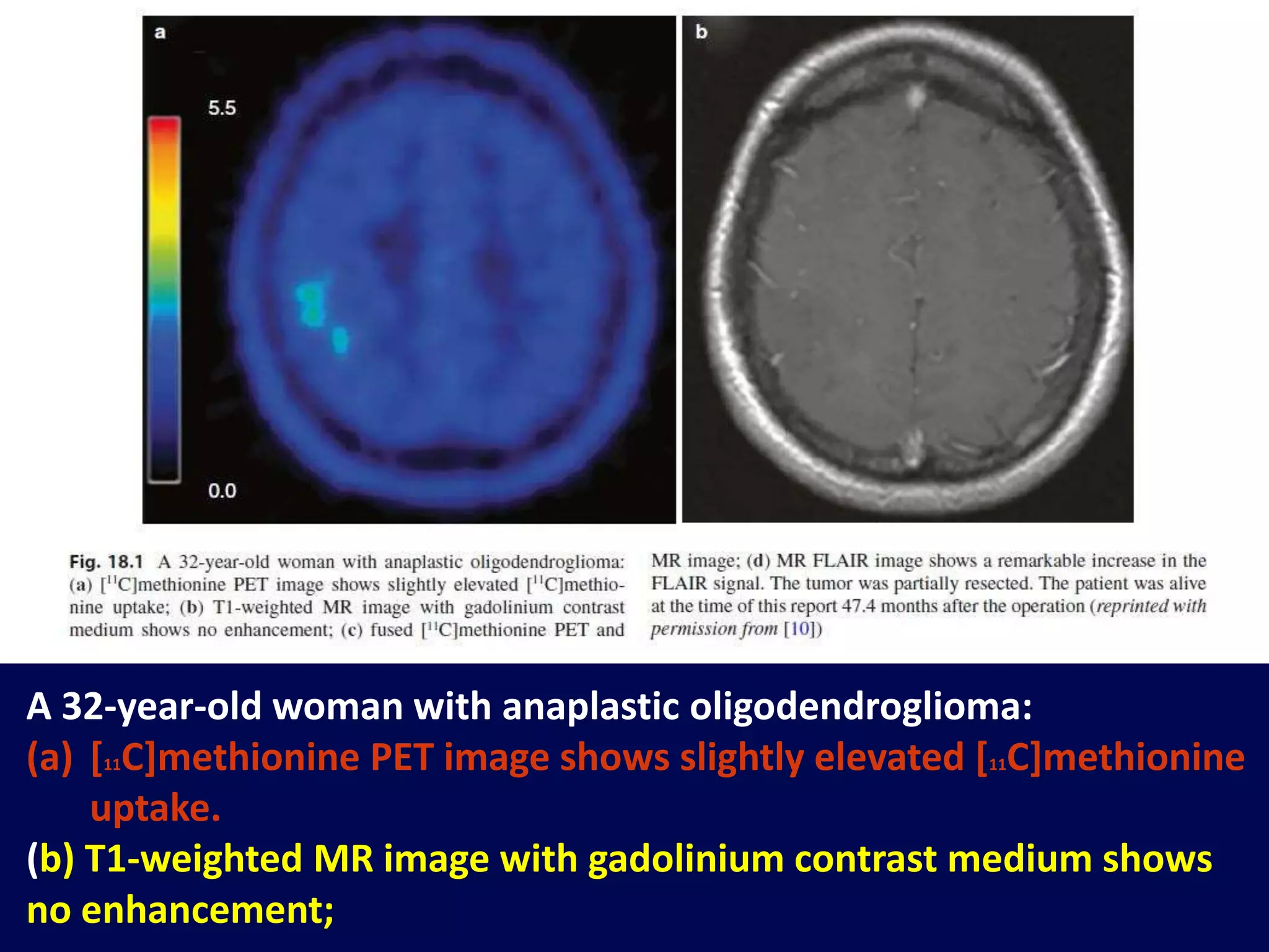 Brain PET imaging | PPTX