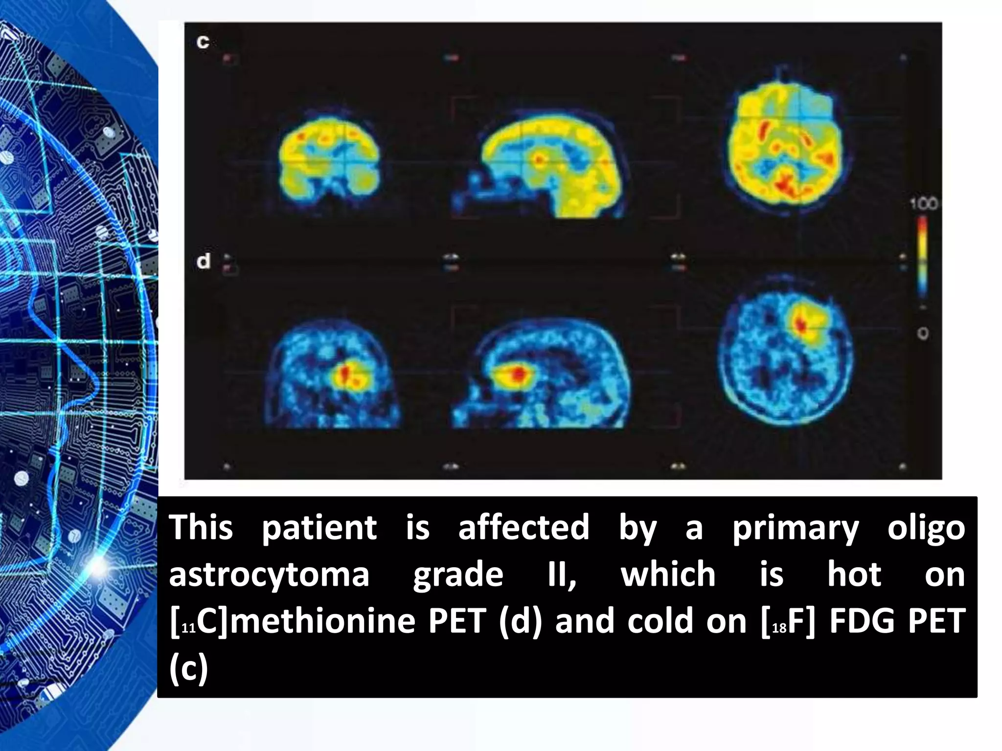 Brain PET imaging | PPTX