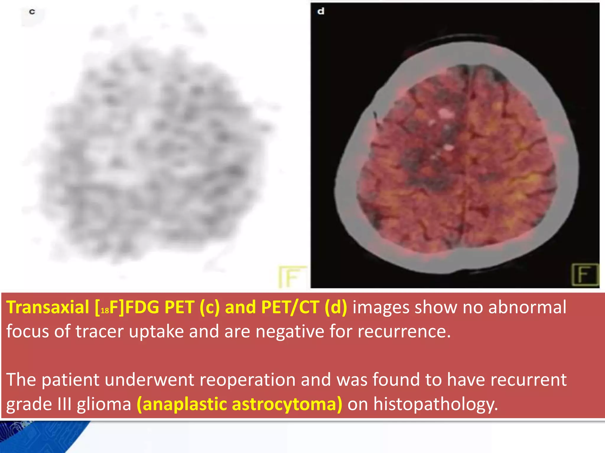 Brain PET imaging | PPTX