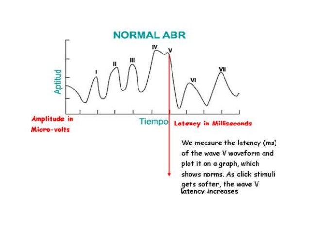 Brainstem auditory evoked responses (baer or abr