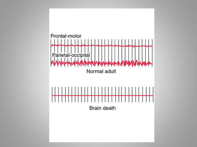 Brain stem death | PPTX