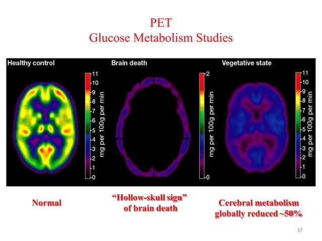 Brain stem death3 | PPT