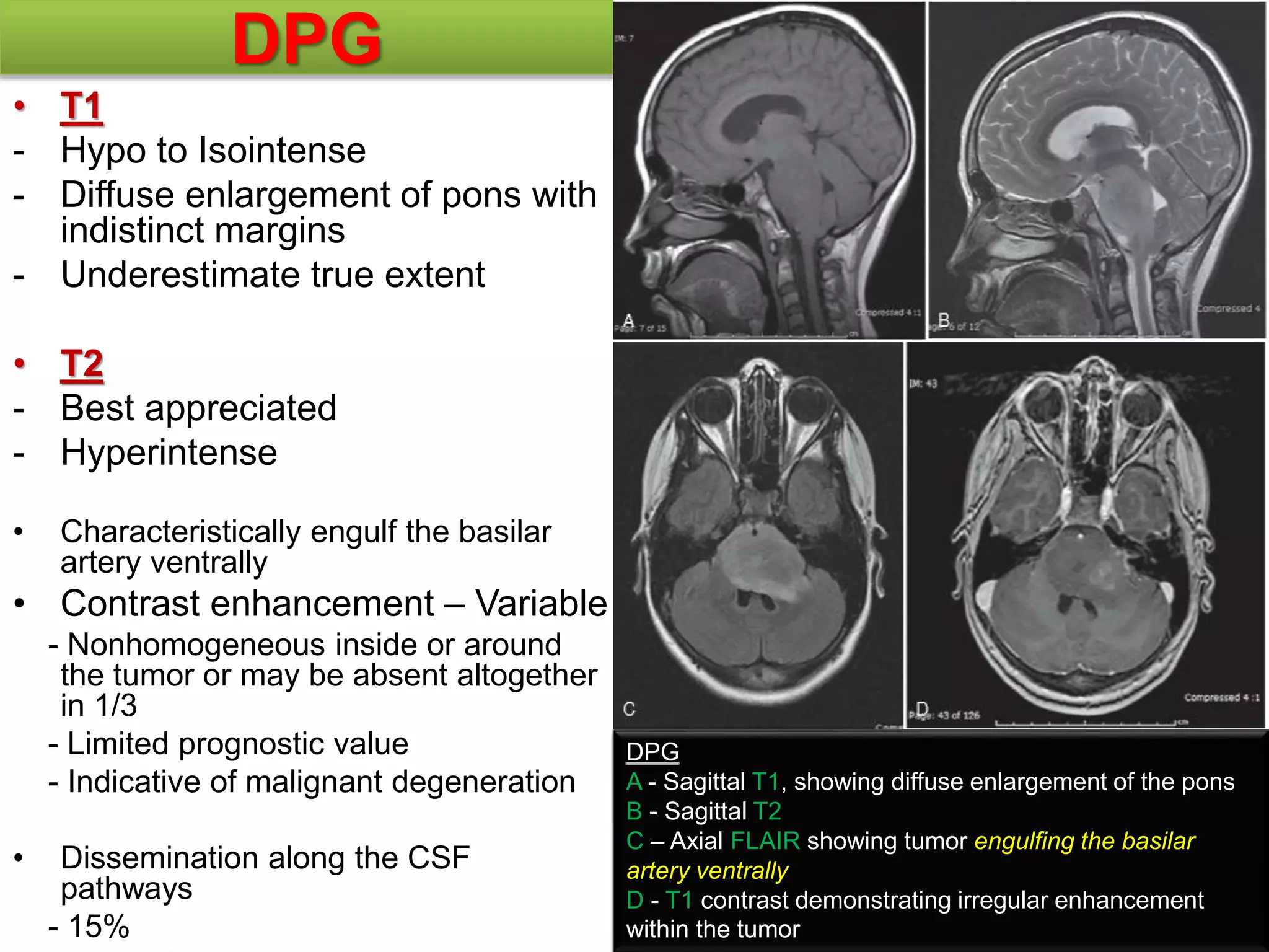 Brainstem glioma part 1 | PPTX