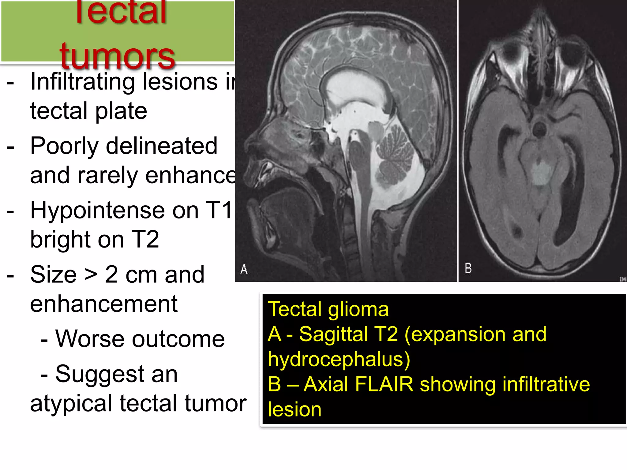 Brainstem glioma part 1 | PPTX