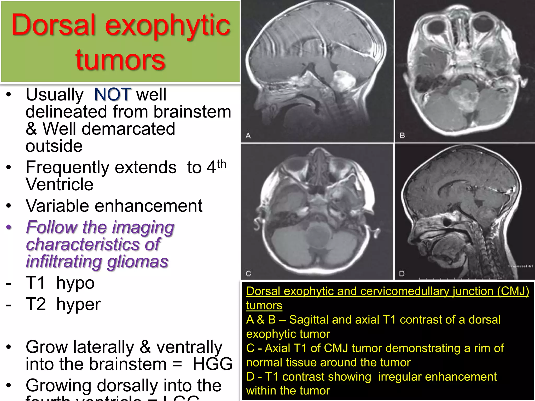 Brainstem glioma part 1 | PPTX