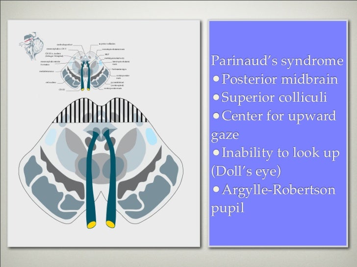 Brainstem Lesions