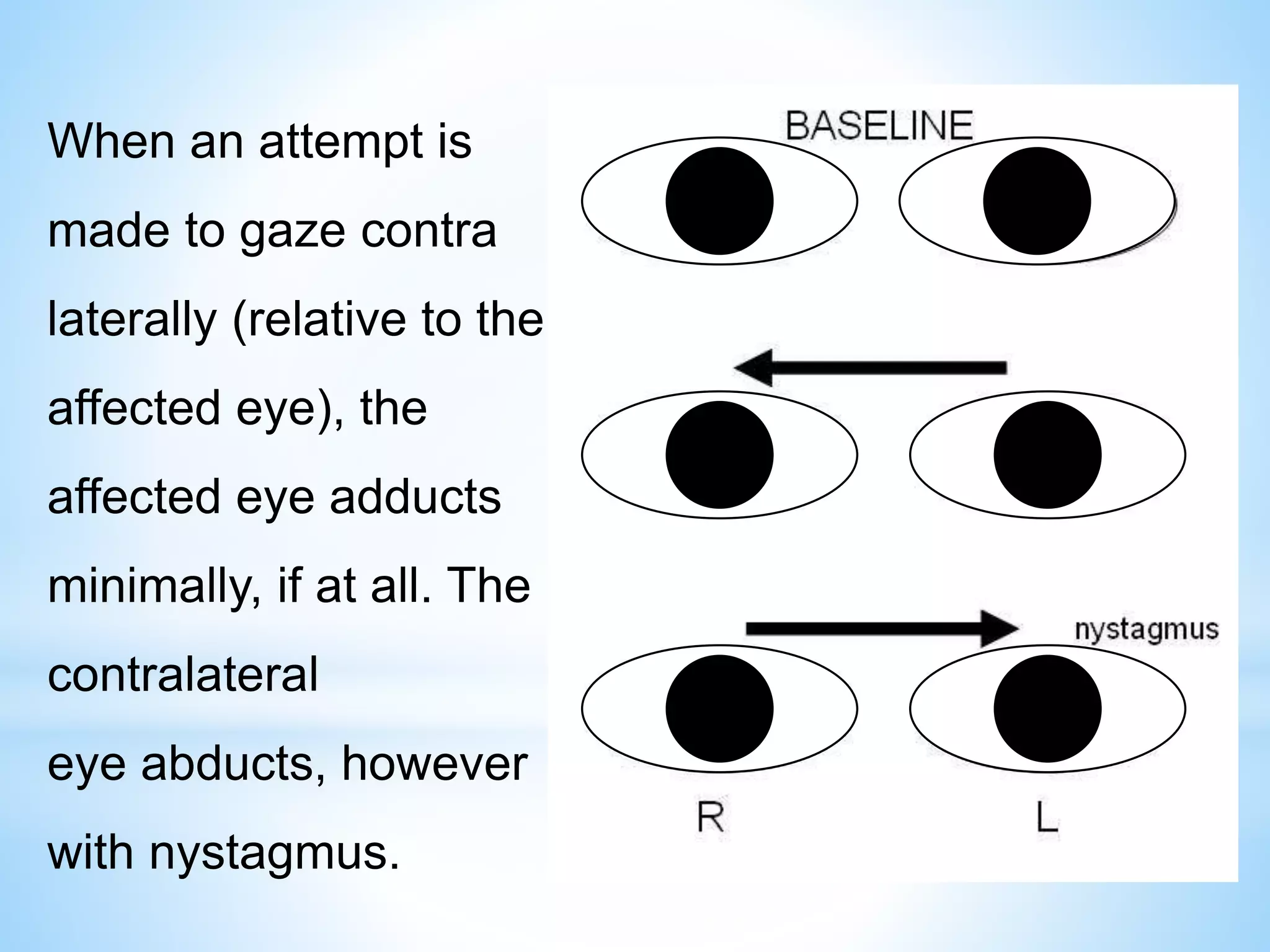 Brain stem Lesions | PPTX