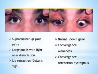 Brain stem Lesions | PPTX