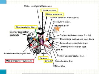 Brainstem stroke syndromes | PPTX