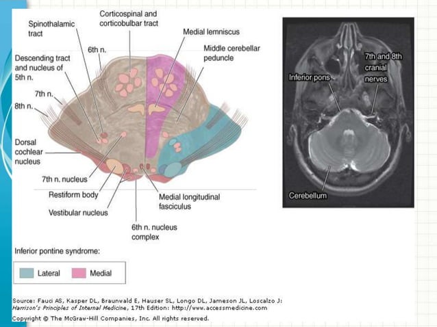 Brainstem stroke syndromes | PPTX
