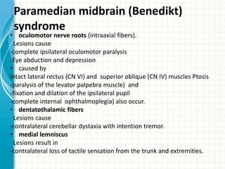Brainstem stroke syndromes | PPTX