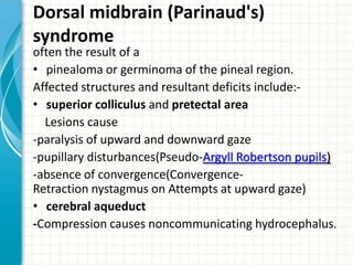 Dorsal Midbrain Parinaud Syndrome S