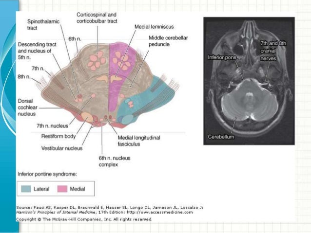 Brainstem stroke syndromes