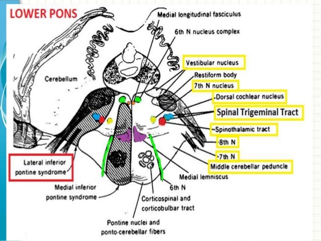 Brainstem stroke syndromes