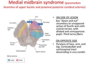 Paramedian Midbrain Syndrome