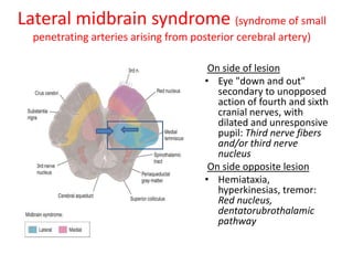 Brainstem stroke syndromes ppt | PPT