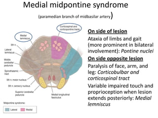 Paramedian Midbrain Syndrome