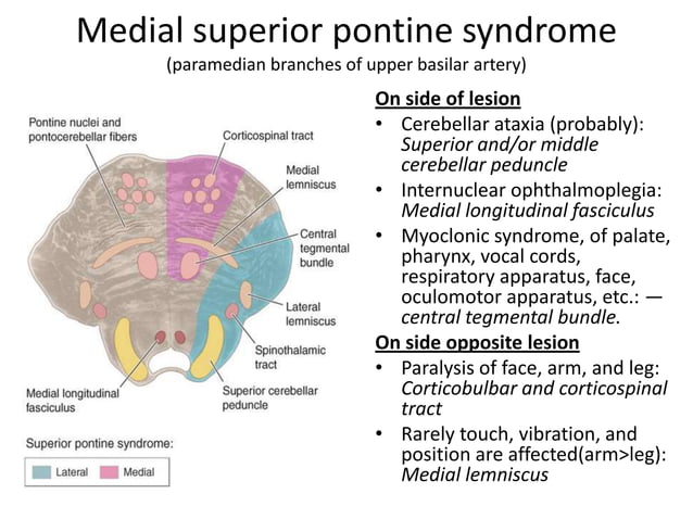 Brainstem stroke syndromes ppt