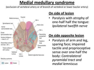 Medial Medullary Stroke Syndromes