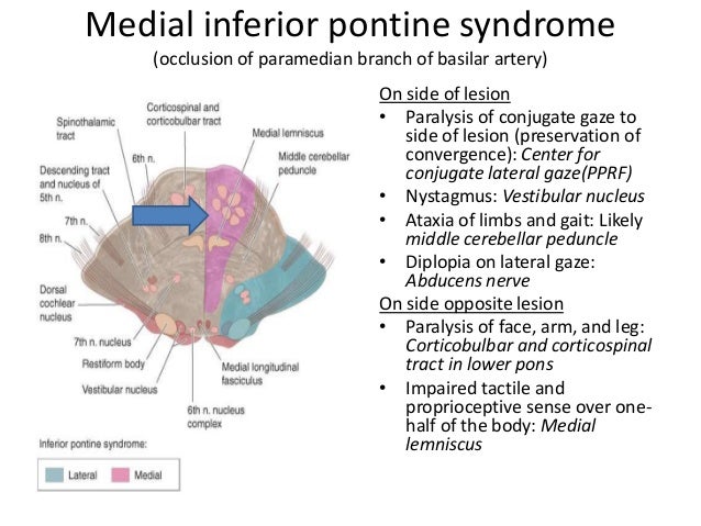 Brainstem stroke syndromes ppt