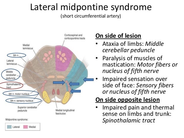 Brainstem Syndromes