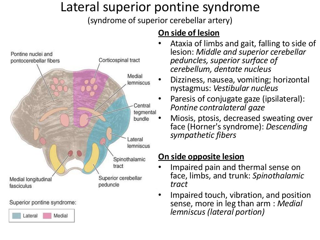 Brainstem stroke syndromes ppt