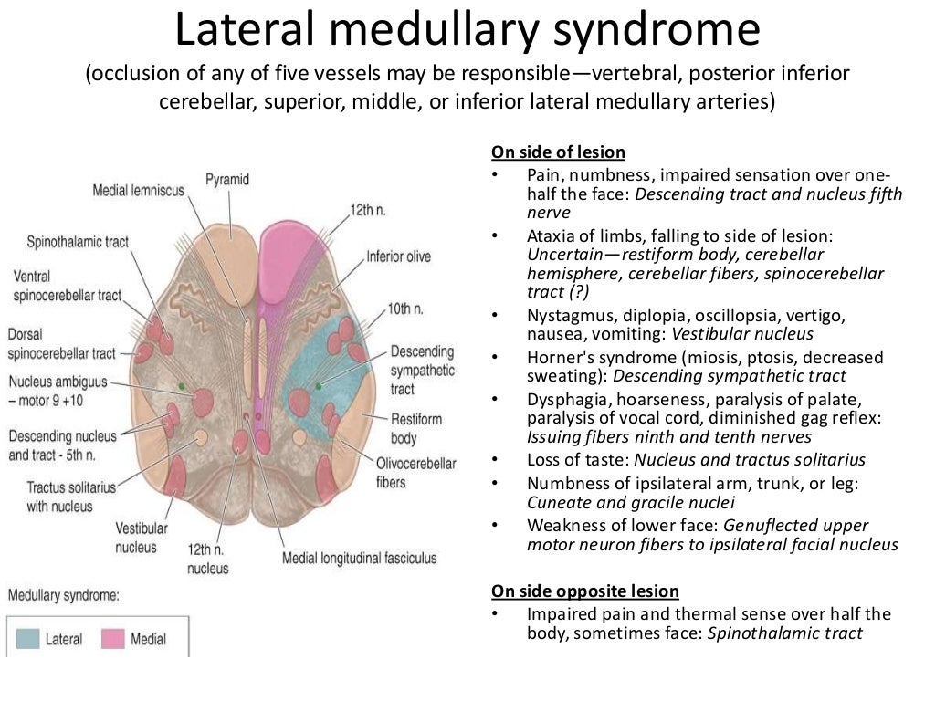 Brainstem stroke syndromes ppt