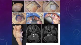 Brain stem surgical anatomy and approaches | PPTX