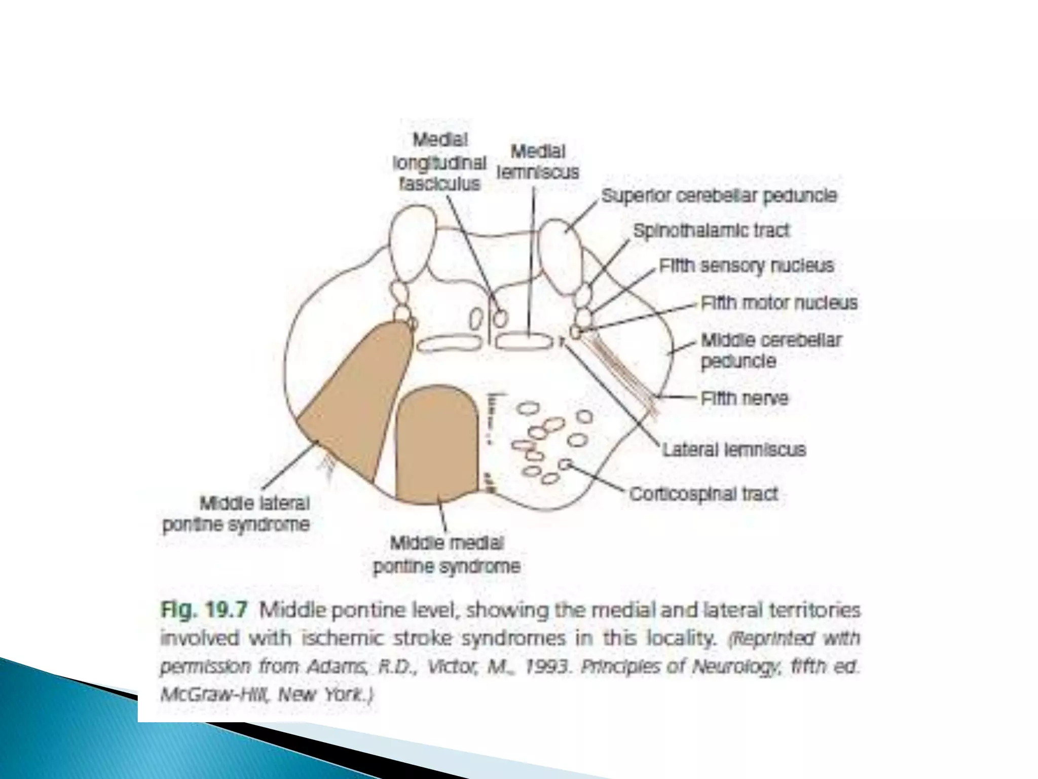 Brain stem syndromes | PPTX