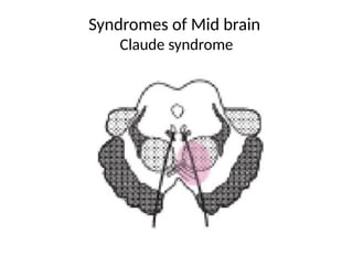 Brain stem syndromes POWER POINT PRESENTATION | PPTX