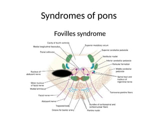 Brain stem syndromes POWER POINT PRESENTATION | PPTX