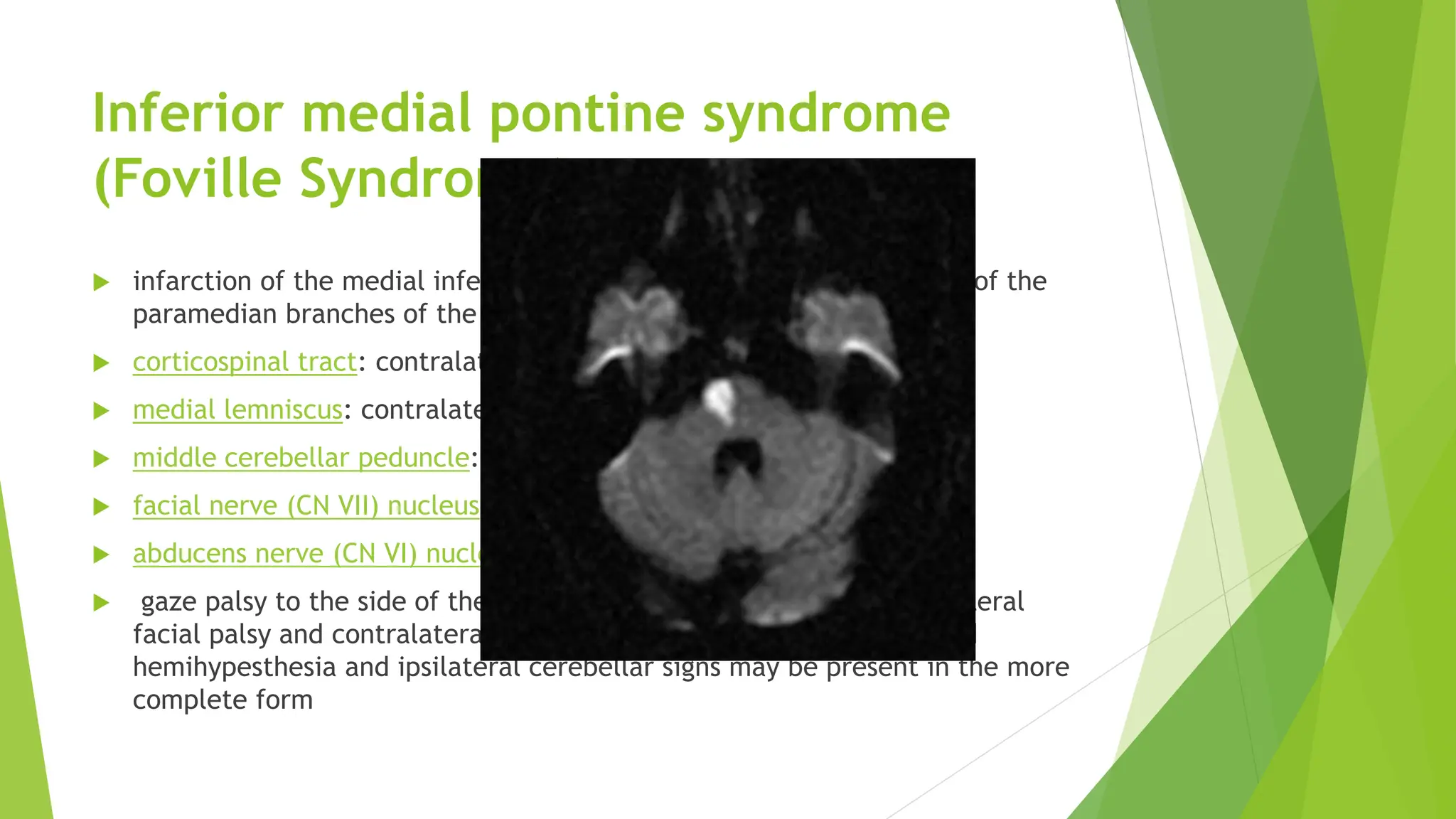 Brainstem Syndromes and multiple Cranial nerve palsies.pptx
