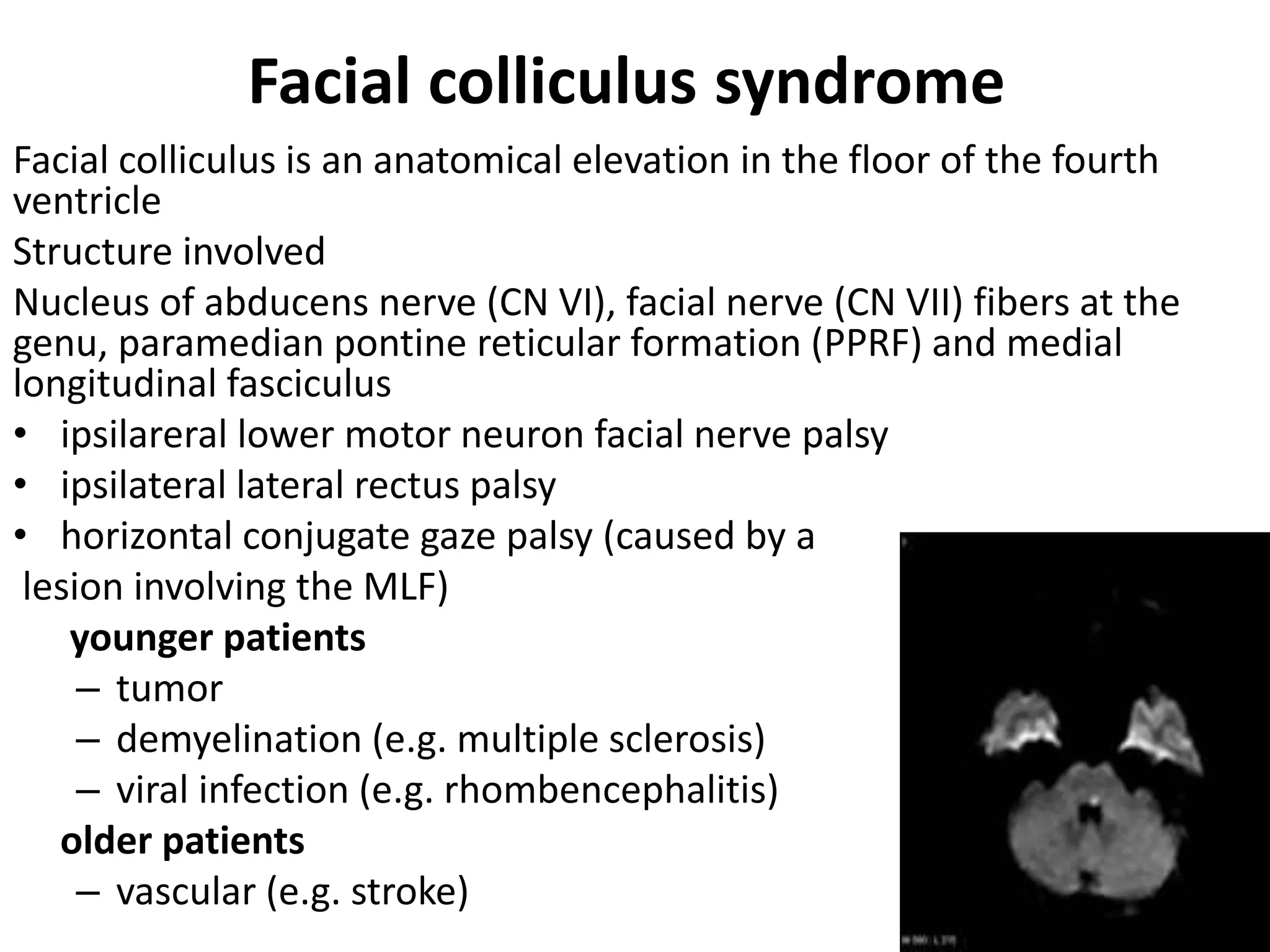 Brainstem syndrome vinod (1) | PPTX